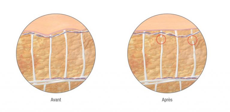 Cellfina pour traitement anti cellulite sans chirurgie - CSHP Paris