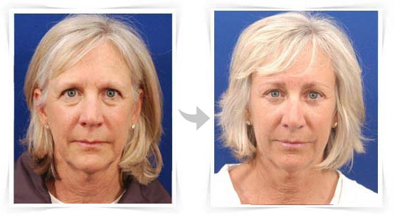 Le lifting facial, chirurgie esthetique pour le visage - CSHP Paris