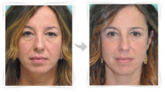 Regard : la chirurgie des paupières, ou blépharoplastie | CSHP Paris