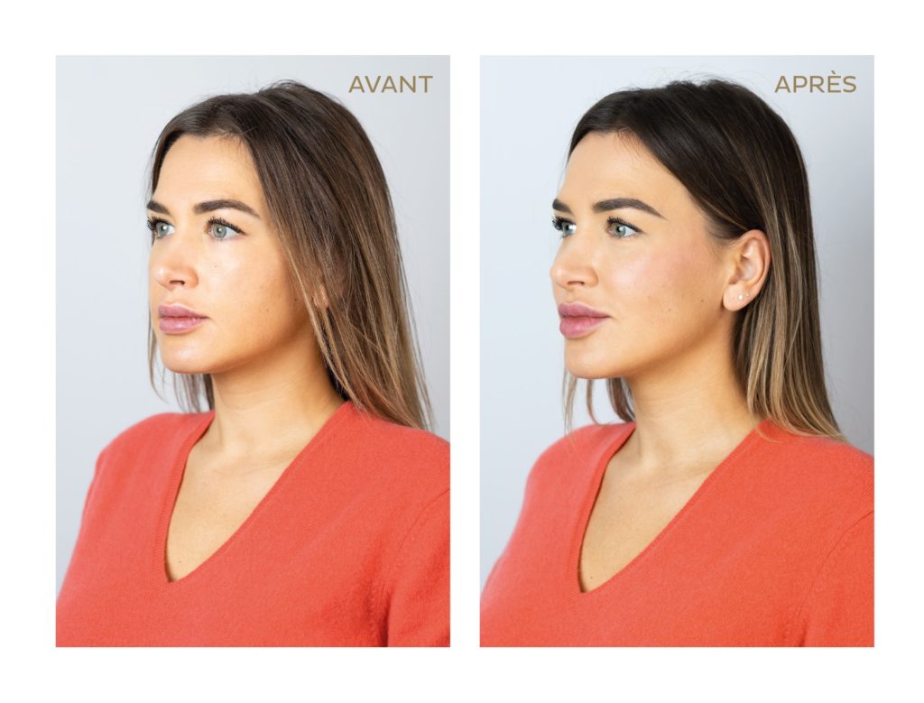 Pommettes et tempes, les traitements esthetiques - CSHP Paris